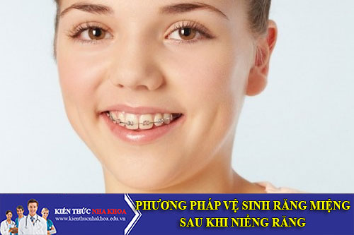 Phương Pháp Vệ Sinh Răng Miệng Sau Khi Niềng Răng